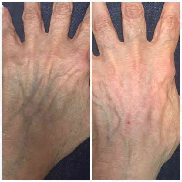 Hand Rejuvenation | Azani Medical Spa