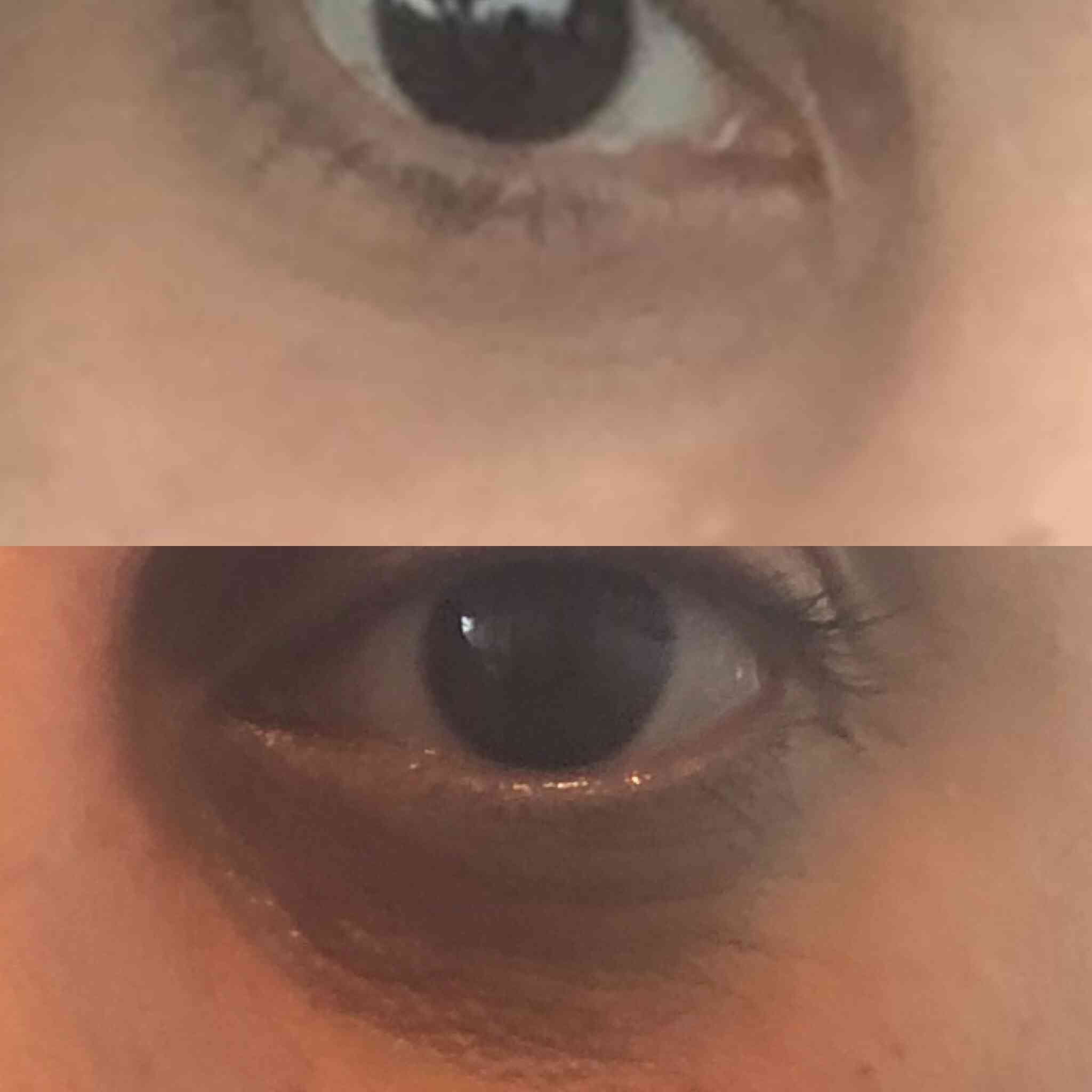 Under eye tear trough filler with Restylane | Azani Medical Spa