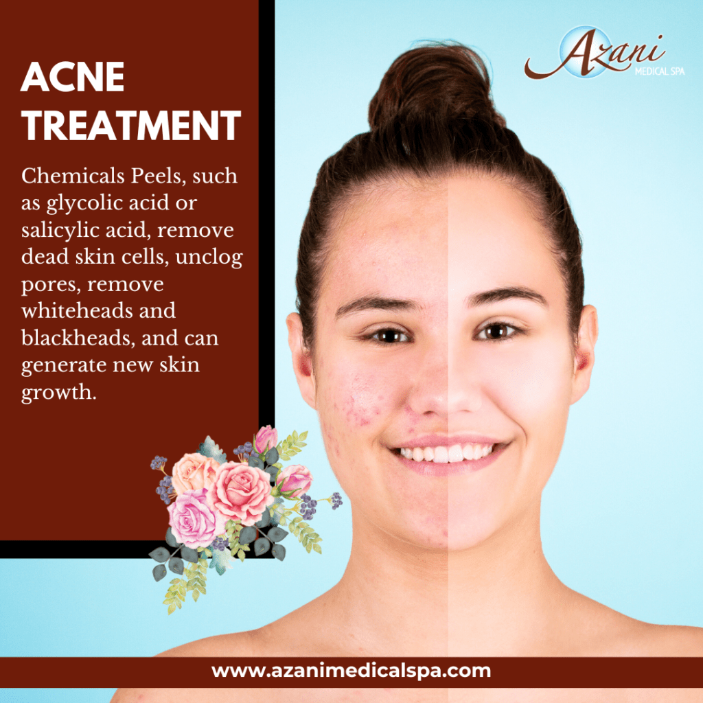 Acne medical treatment | Azani Medical Spa