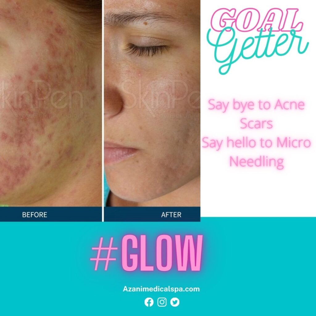 Acne medical treatment | Azani Medical Spa